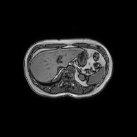 Liver Tumor Semantic Segmentation Semantic Segmentation Dataset by RVB