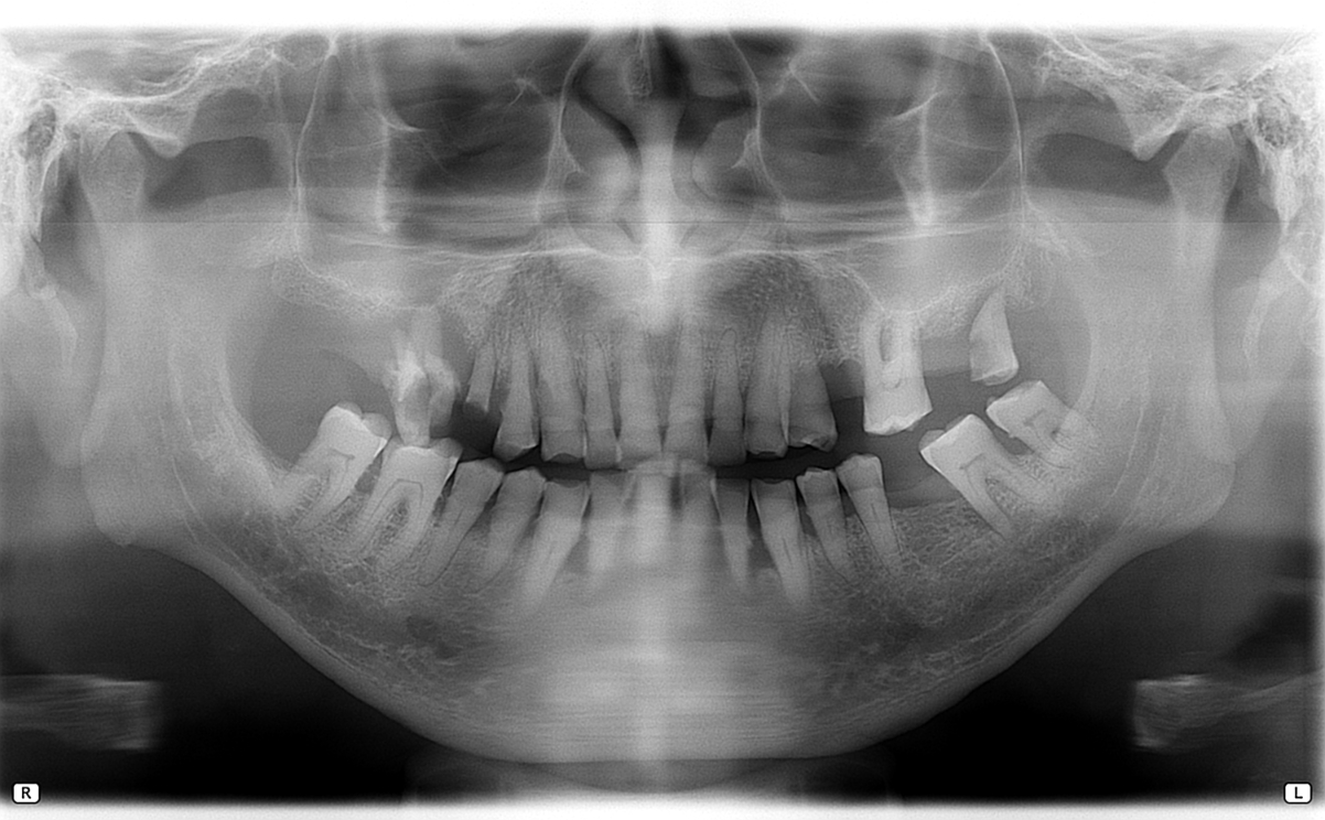 Teeth X-ray Object Detection Dataset and Pre-Trained Model by ML