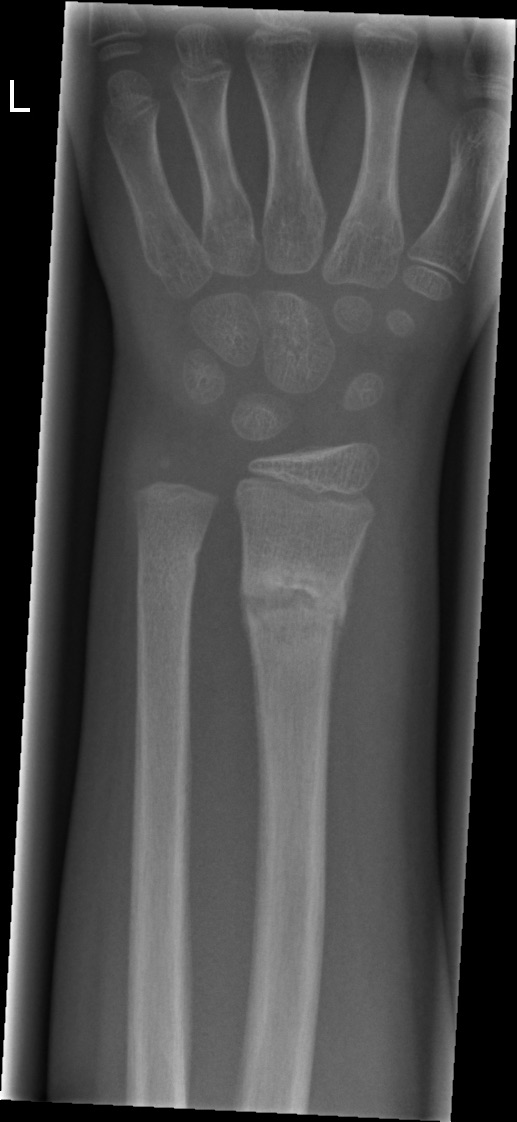 FractureX: Wrist Dataset Object Detection Dataset and Pre-Trained Model by Science Research