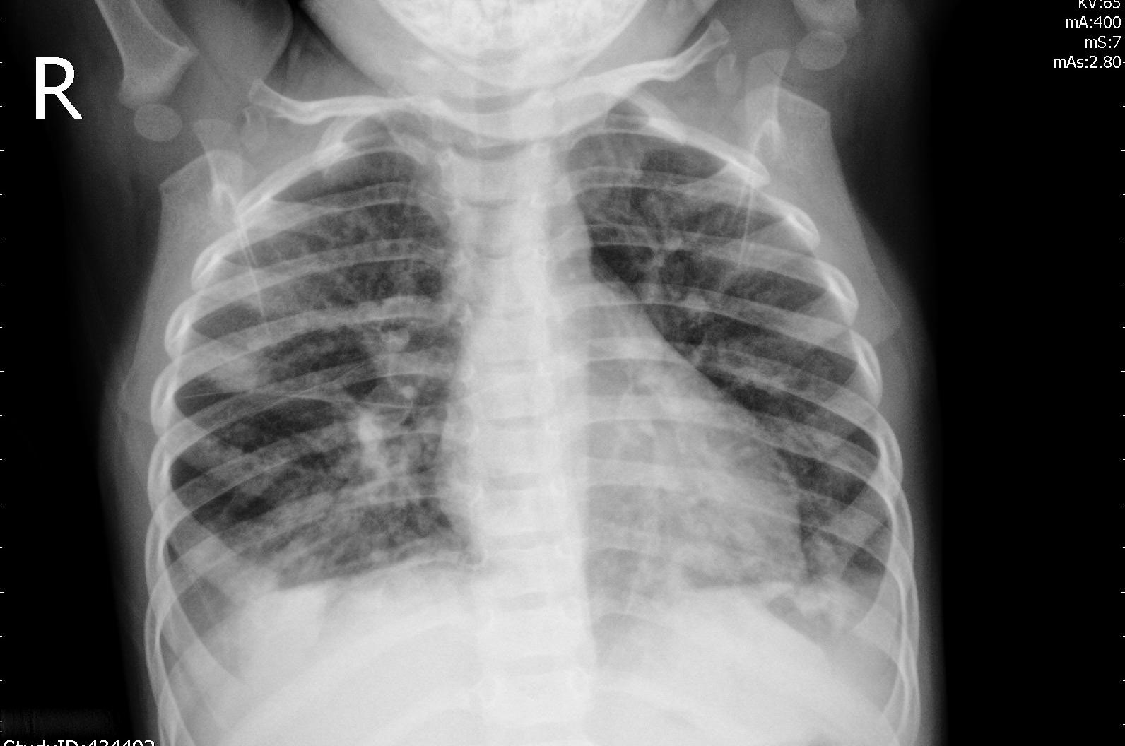 Pneumonia Detection Object Detection Dataset and Pre-Trained Model by ...