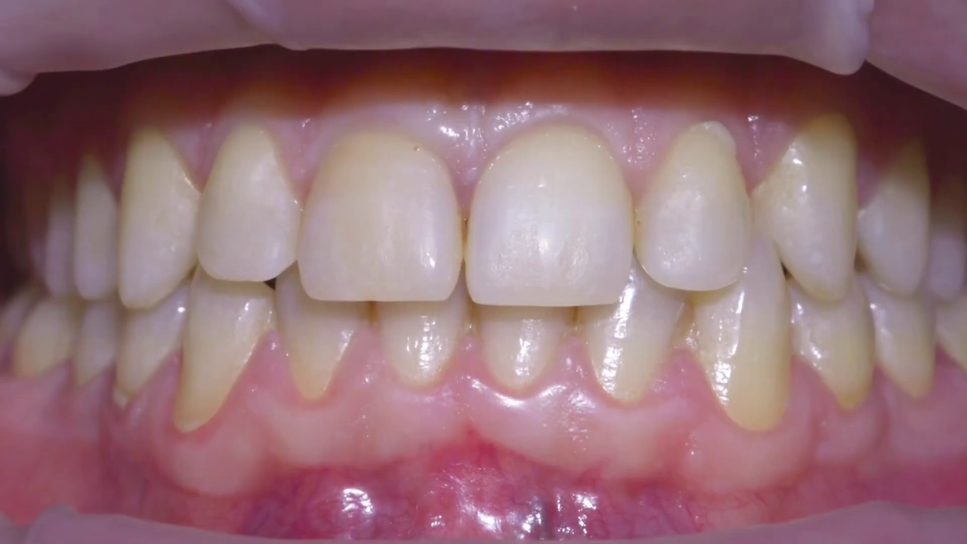 Dental Object Detection Dataset By Dataset