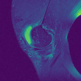Knee-Mri-Classification Classification Dataset by tysonbratt