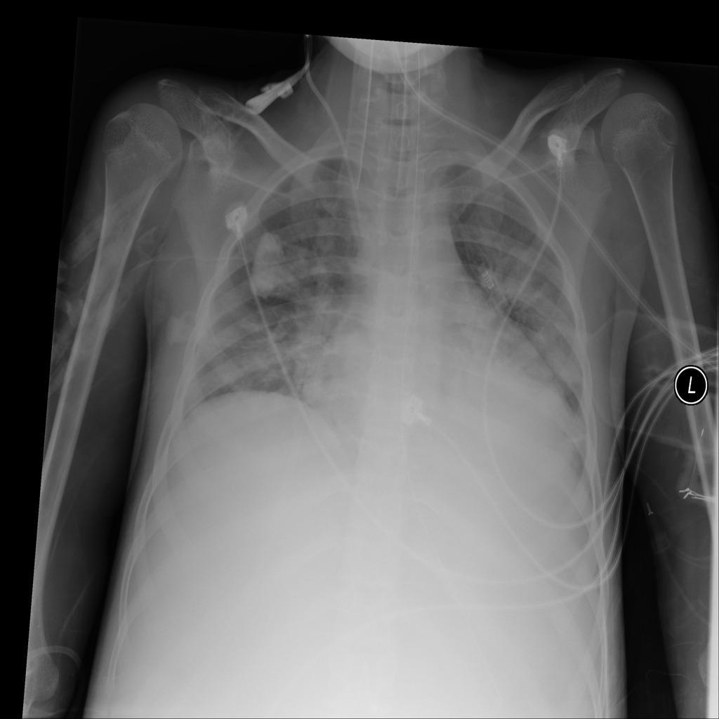 Pneumonia Segmentation Instance Segmentation Dataset and Pre-Trained Model by hpUoS
