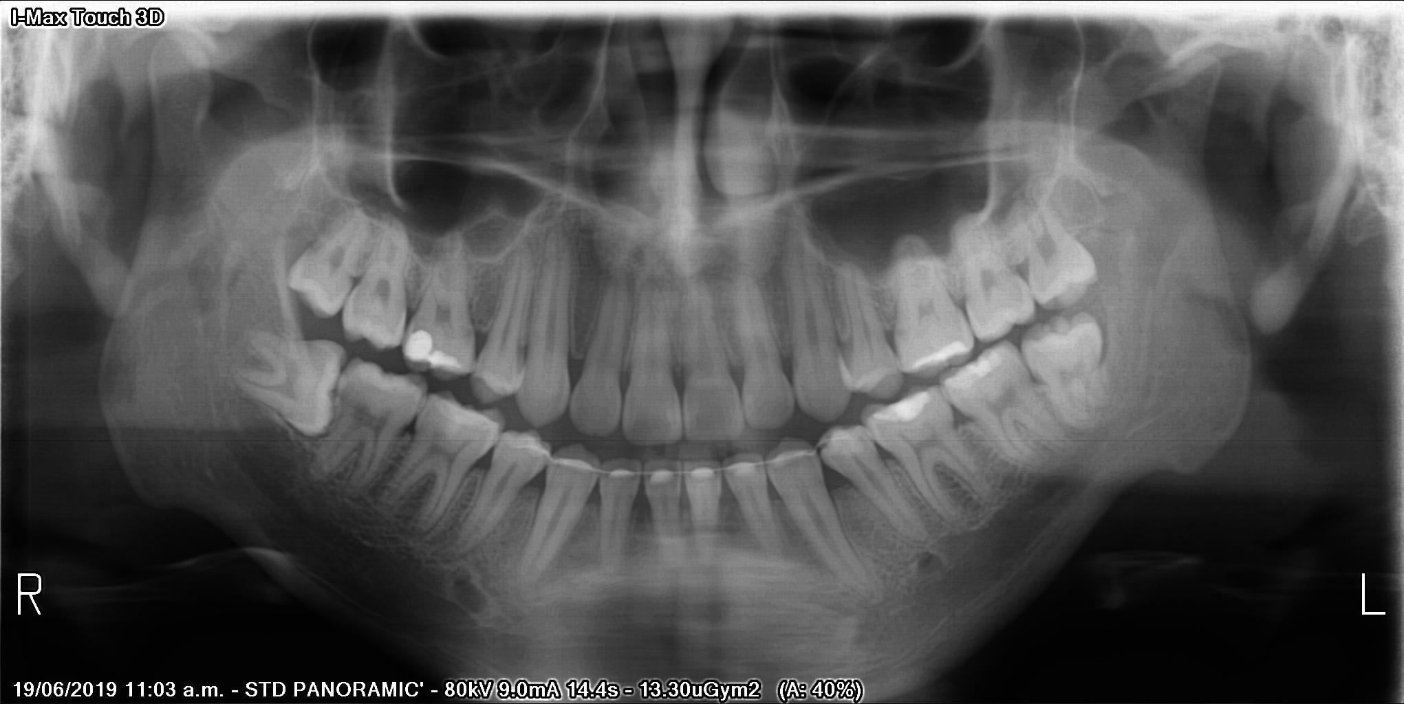 How to Use the Teeth Segmentation Instance Segmentation API