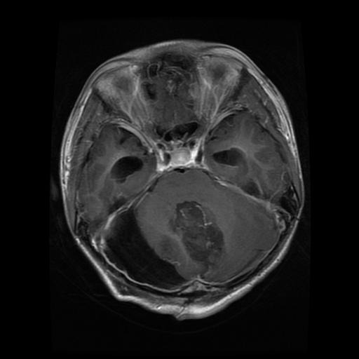 Brain Tumor Classification Dataset And Pre Trained Model By Omg Its Me