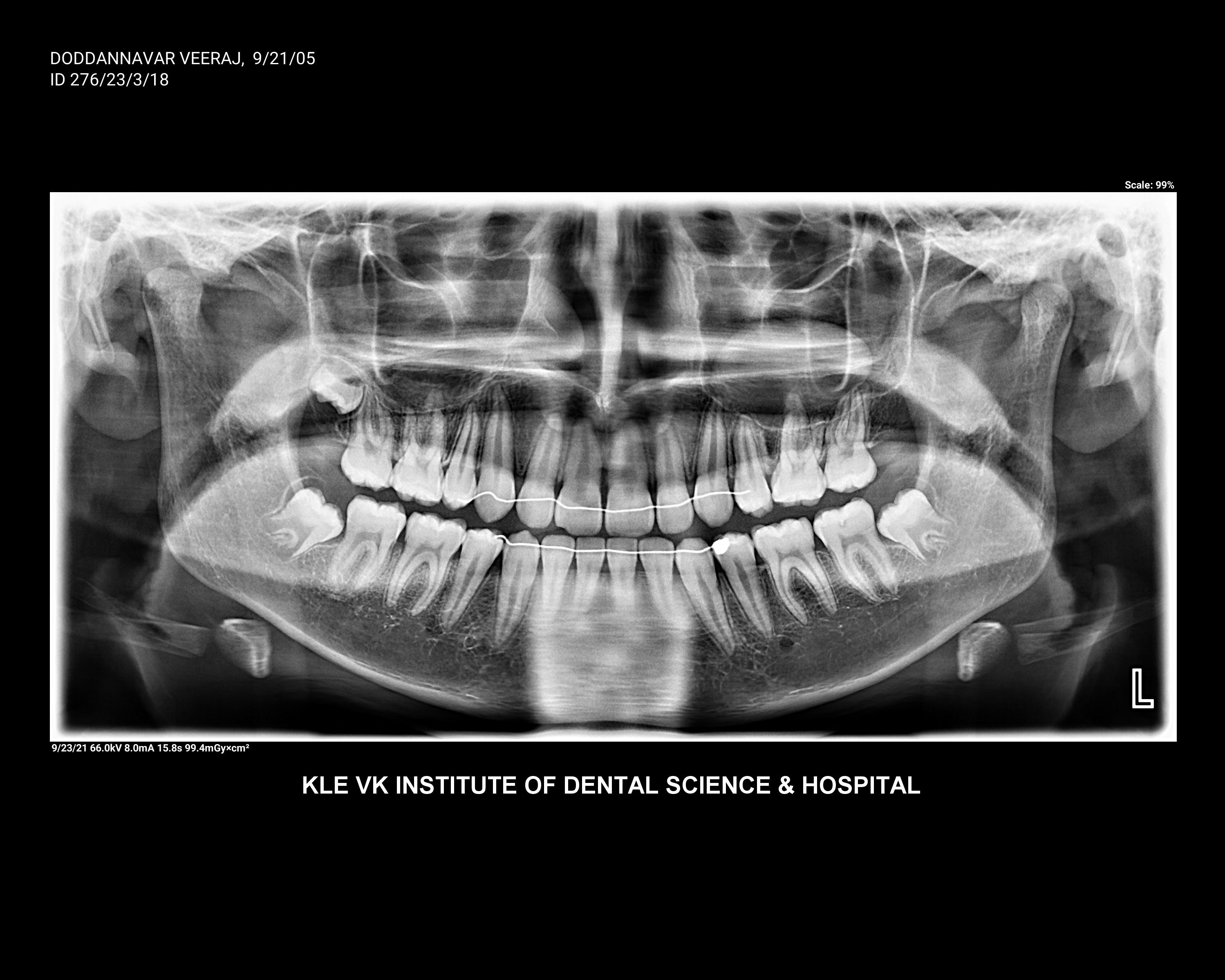 TOOTH SEGMENTATIONa Instance Segmentation Dataset (v1, 2023-08-16 10 ... TOOTH SEGMENTATIONa Instance Segmentation Dataset (v1, 2023-08-16 10 ...