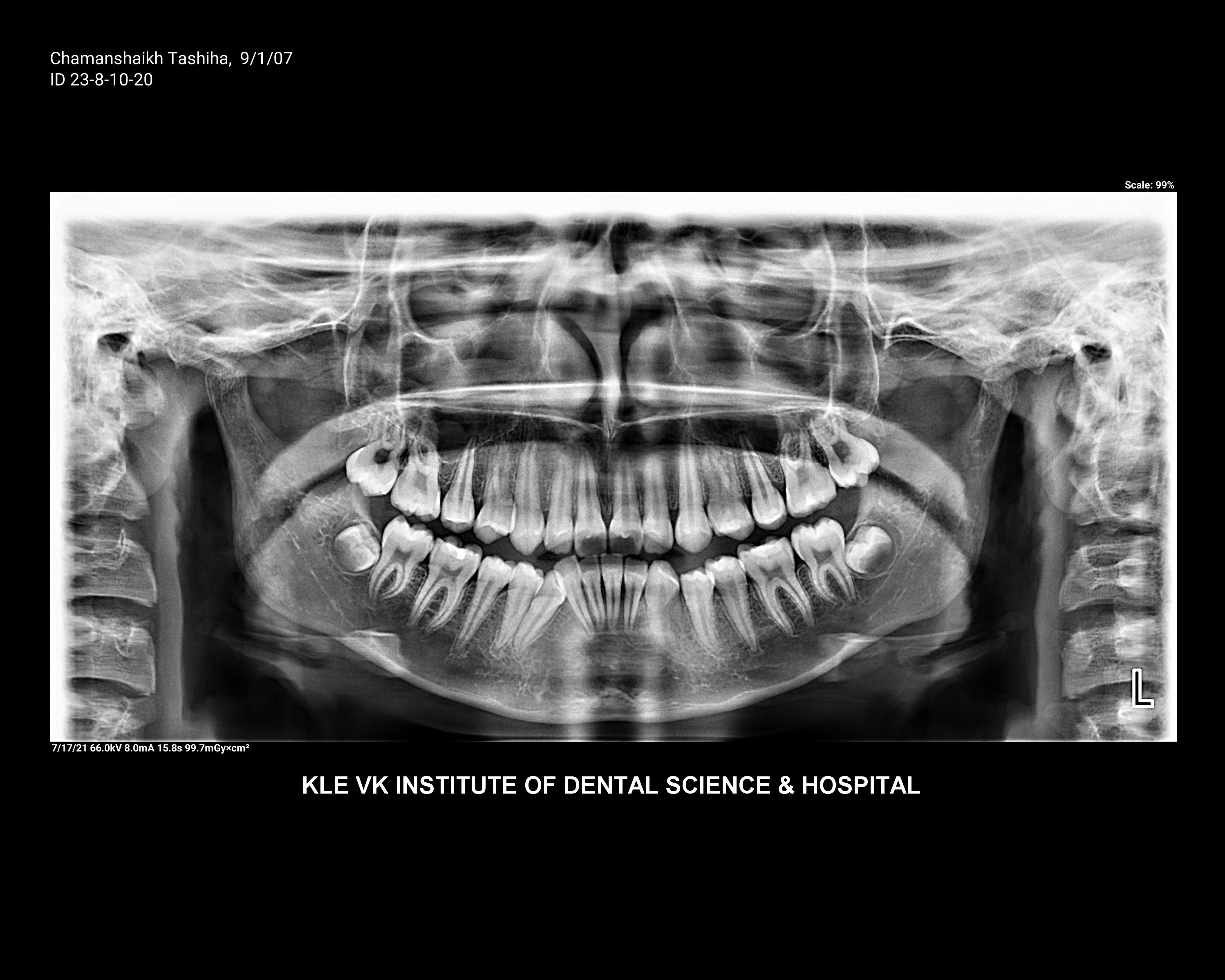 TOOTH SEGMENTATION Instance Segmentation Dataset and Pre-Trained Model by TEETH SEGMENTATION