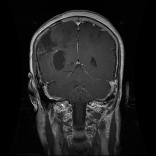 cancer from brain MRI Object Detection Dataset and Pre-Trained Model by ...
