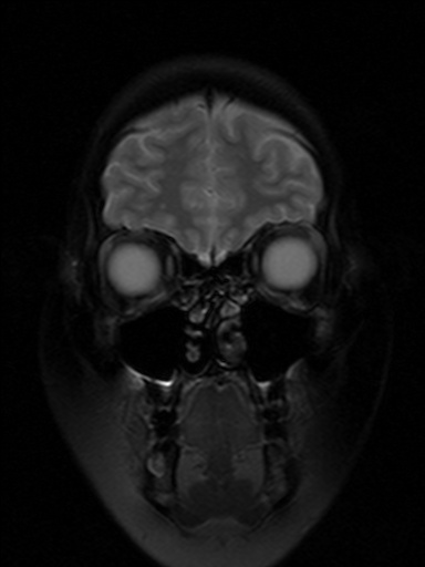 Coronal_Segmentation Object Detection Dataset and Pre-Trained Model by ...