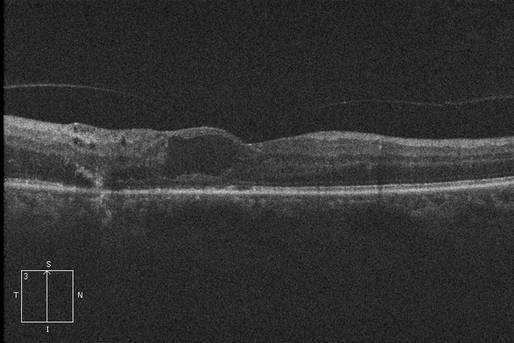 Retinal OCT Images Classification Dataset by Unitec