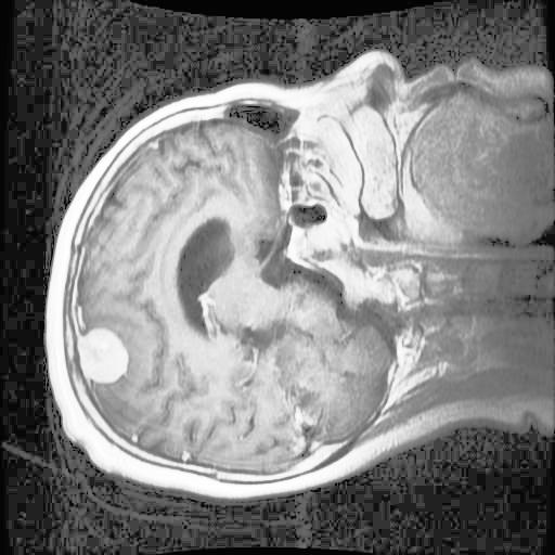 Tumor Otak Object Detection Dataset And Pre Trained Model By Gunadarma