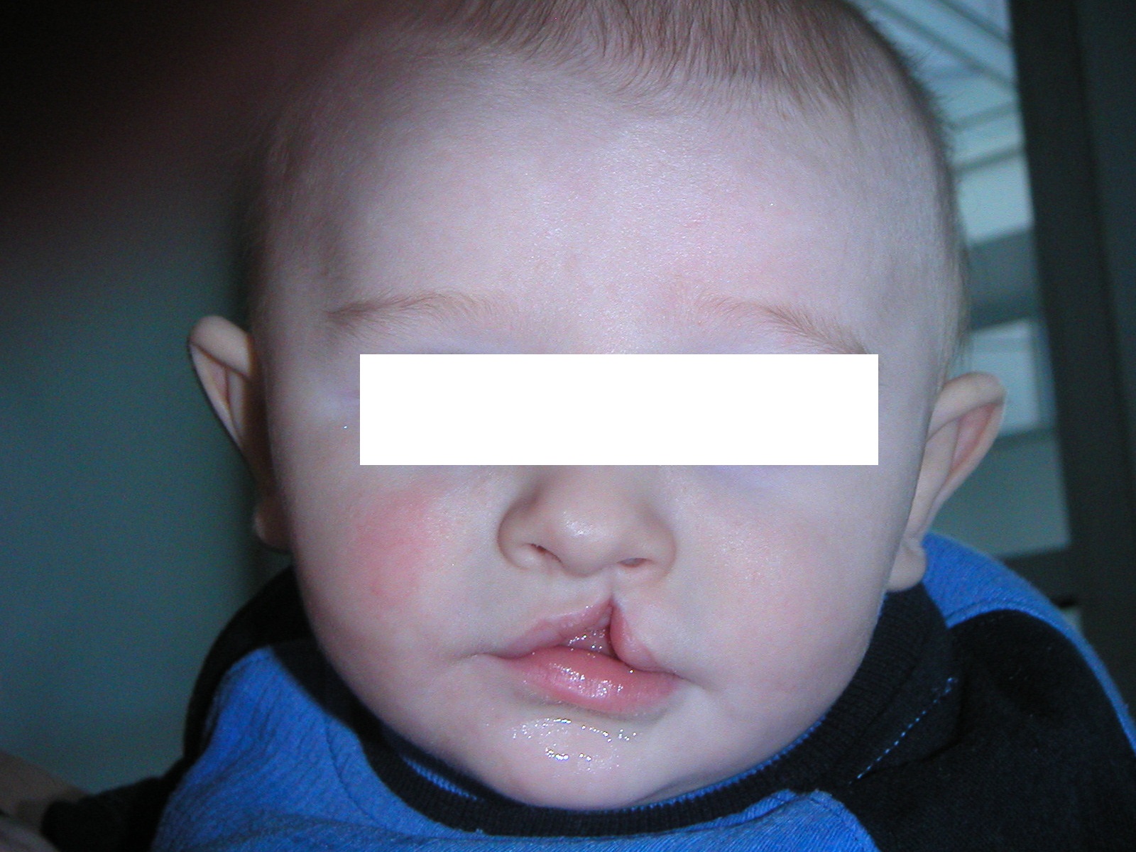 cleft lip detections Object Detection Dataset and Pre-Trained Model by ...