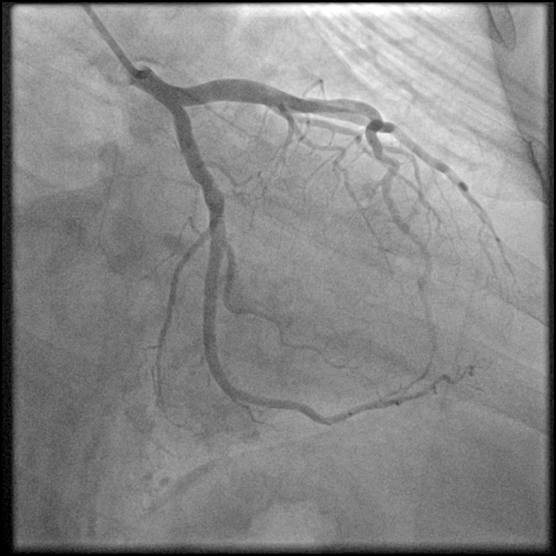 arcade val set Instance Segmentation Dataset by Coronary Angiography