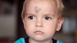 bruise Object Detection Dataset and Pre-Trained Model by TraumaAI