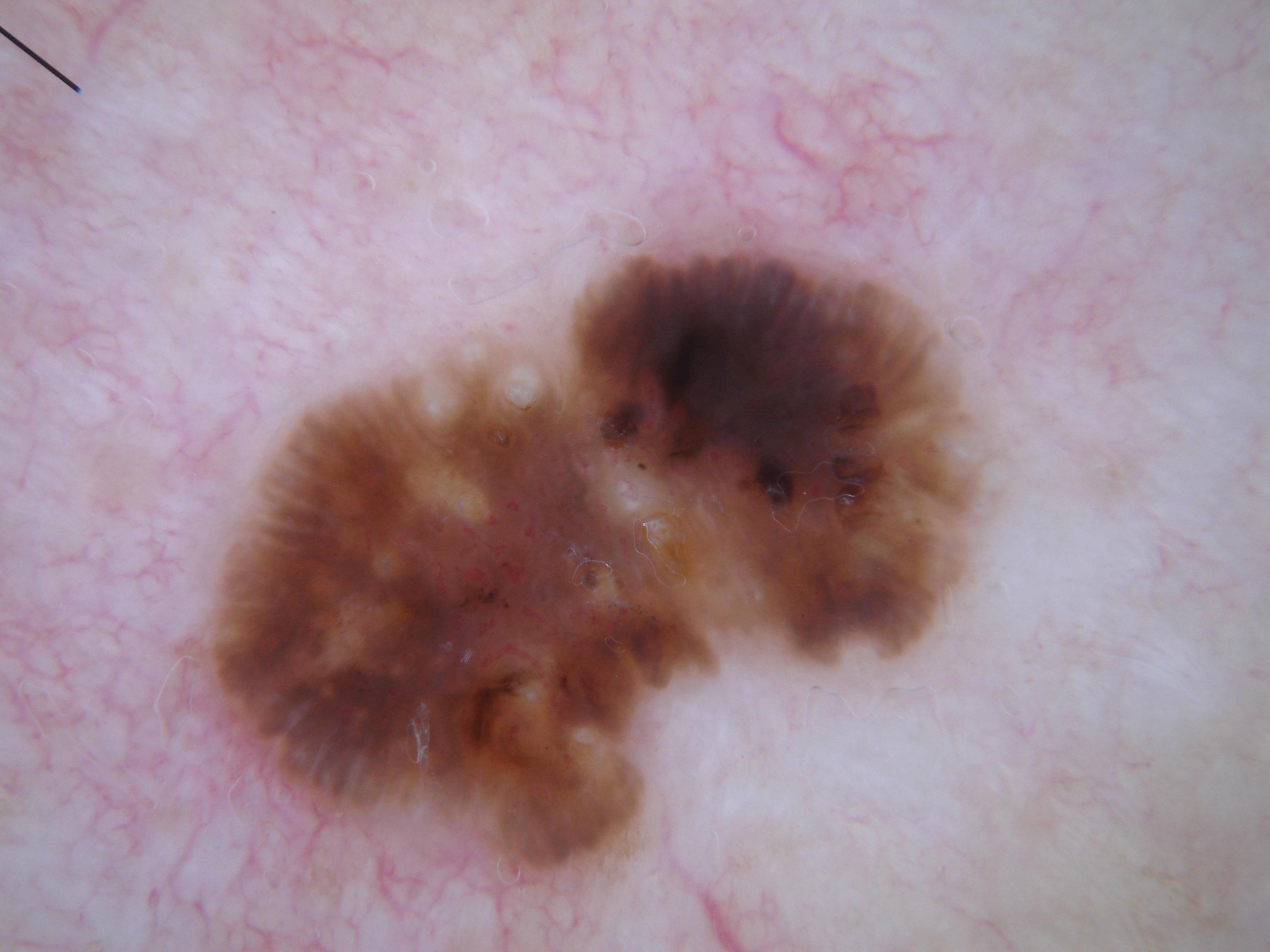 seborrheic keratosis Classification Dataset by SkinCareClassification