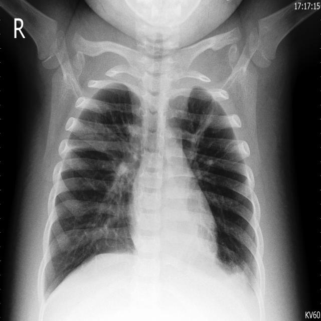 Single-label Classification of Lung Diseases Classification Dataset and ...