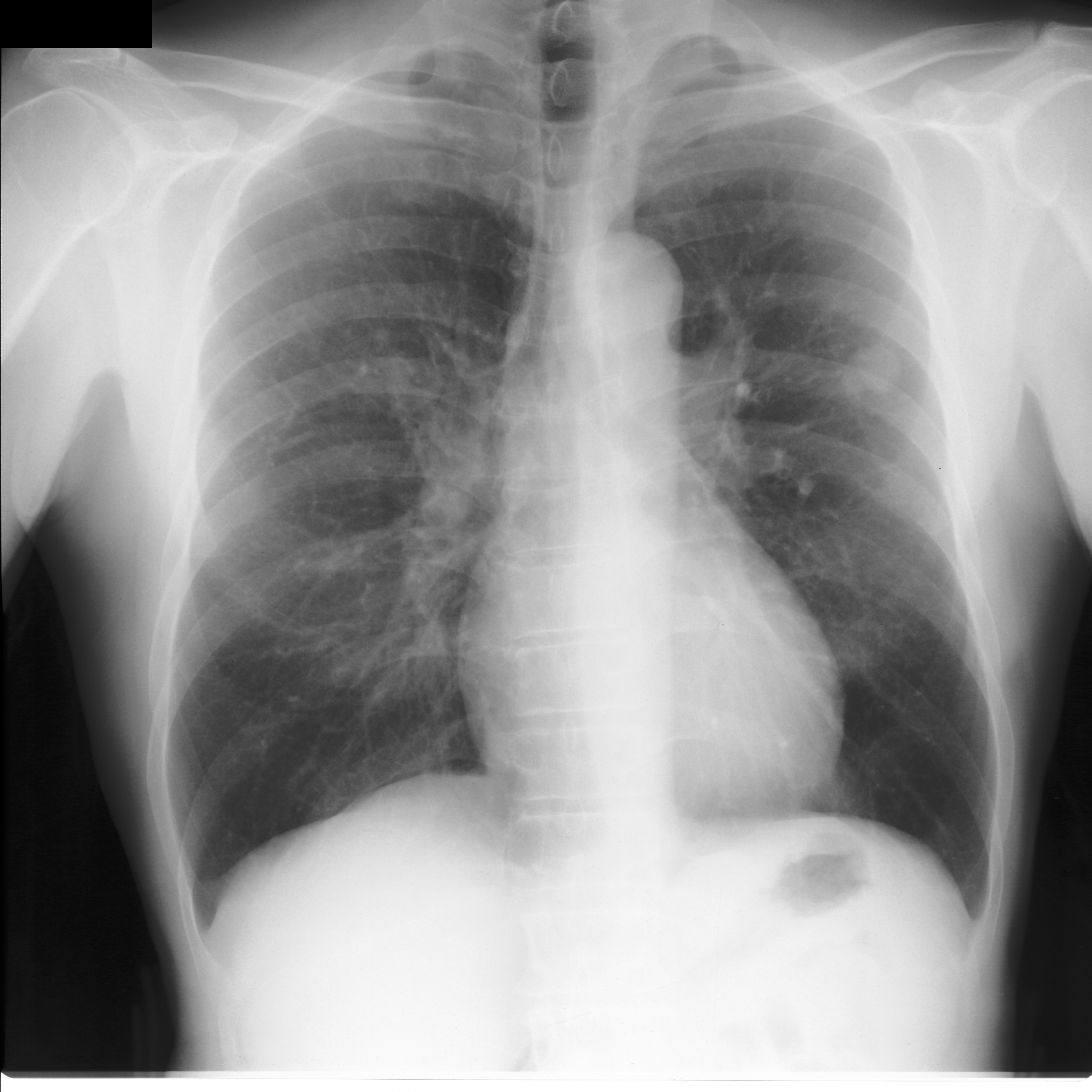 XRay Chest Nodule Object Detection Dataset By XRay Chest Nodule