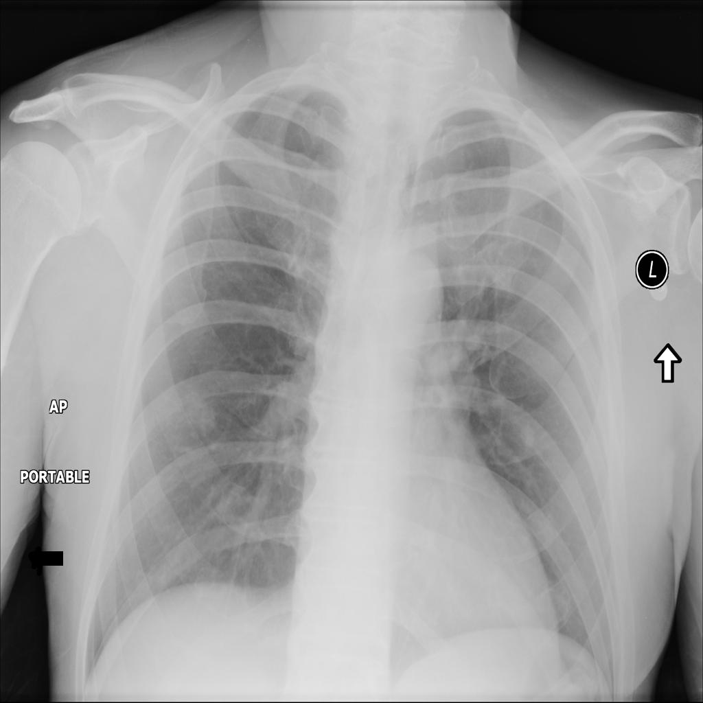 XRay Chest Nodule - Roboflow Universe
