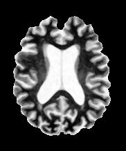 Brain MRI preprocessing Classification Dataset and Pre-Trained Model by ...