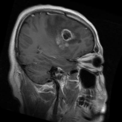 brain_tumor Object Detection Dataset by BEYZA