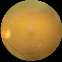 Retinal Disease Classification Classification Dataset by ...