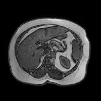 Liver Tumor Object Detection Dataset by Liver2