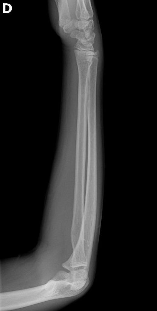Intelligent Bone Fracture Detection System Object Detection Dataset And Pre Trained Model By