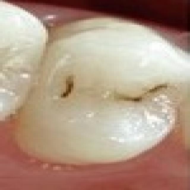 Tooth Cavities Detection Object Detection Dataset And Pre Trained Model By Project Vgzbd