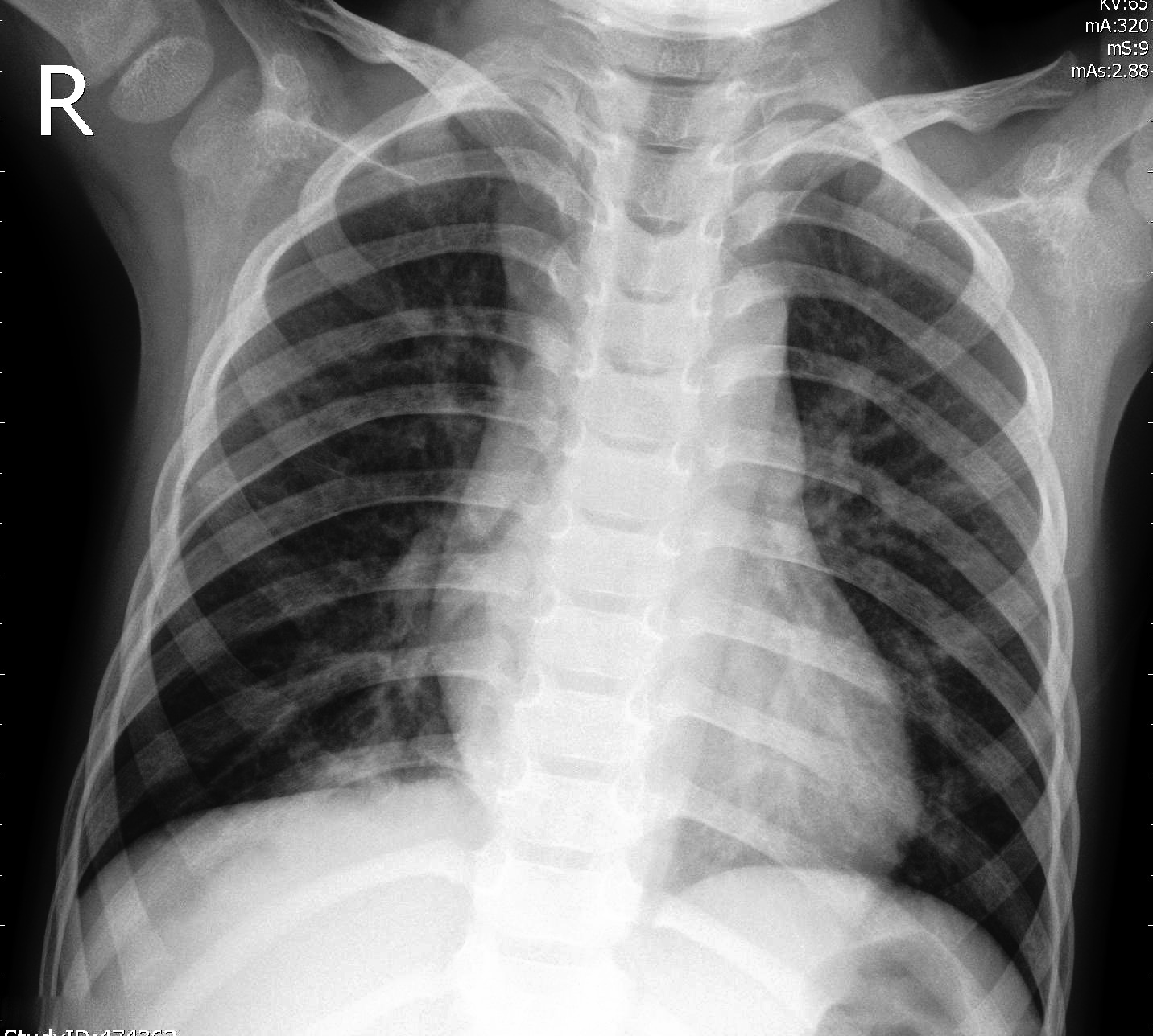 Lungs Cancer Instance Segmentation Dataset by Samiullah