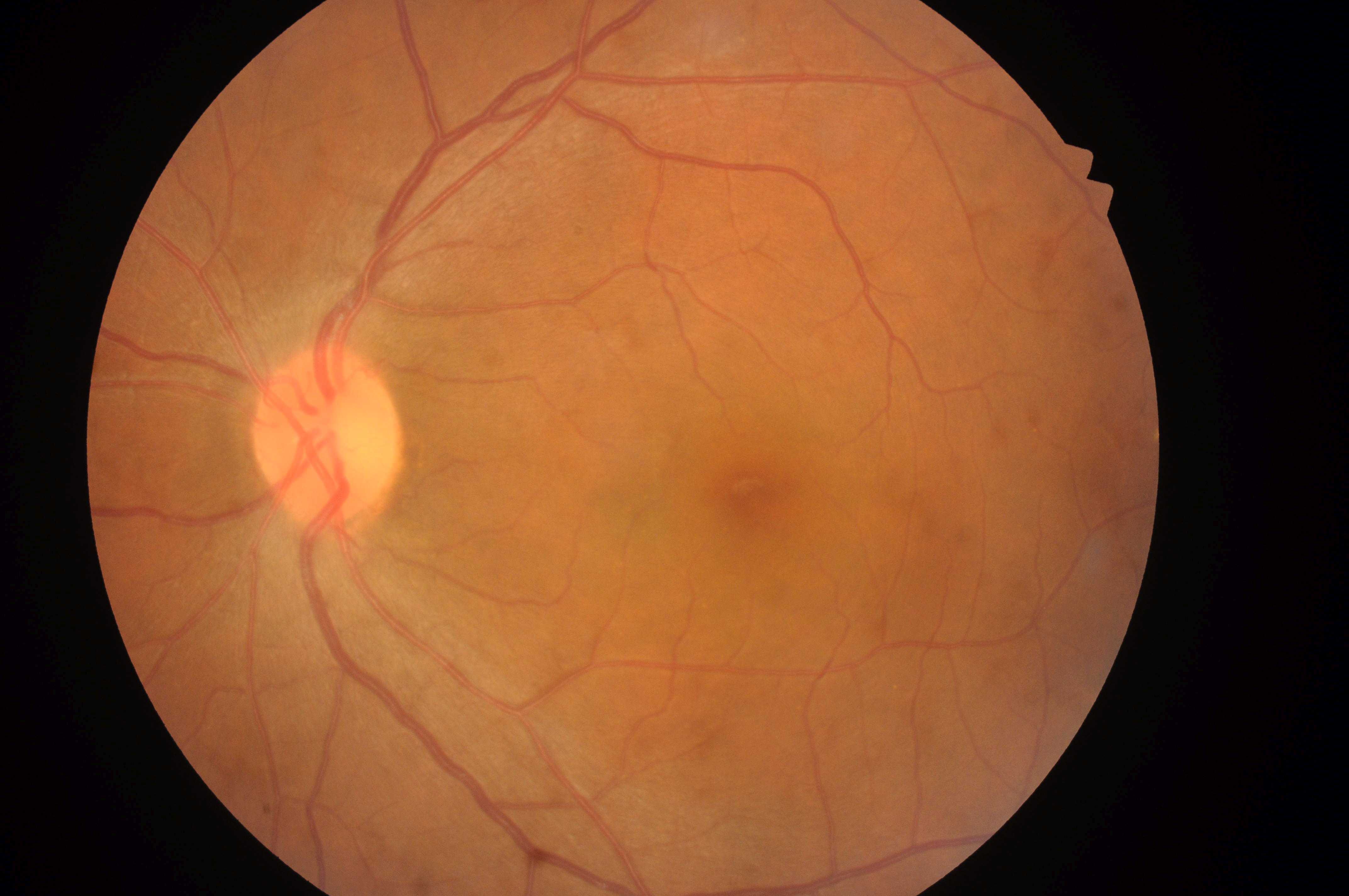 idrid_org Classification Dataset by Ajmodel