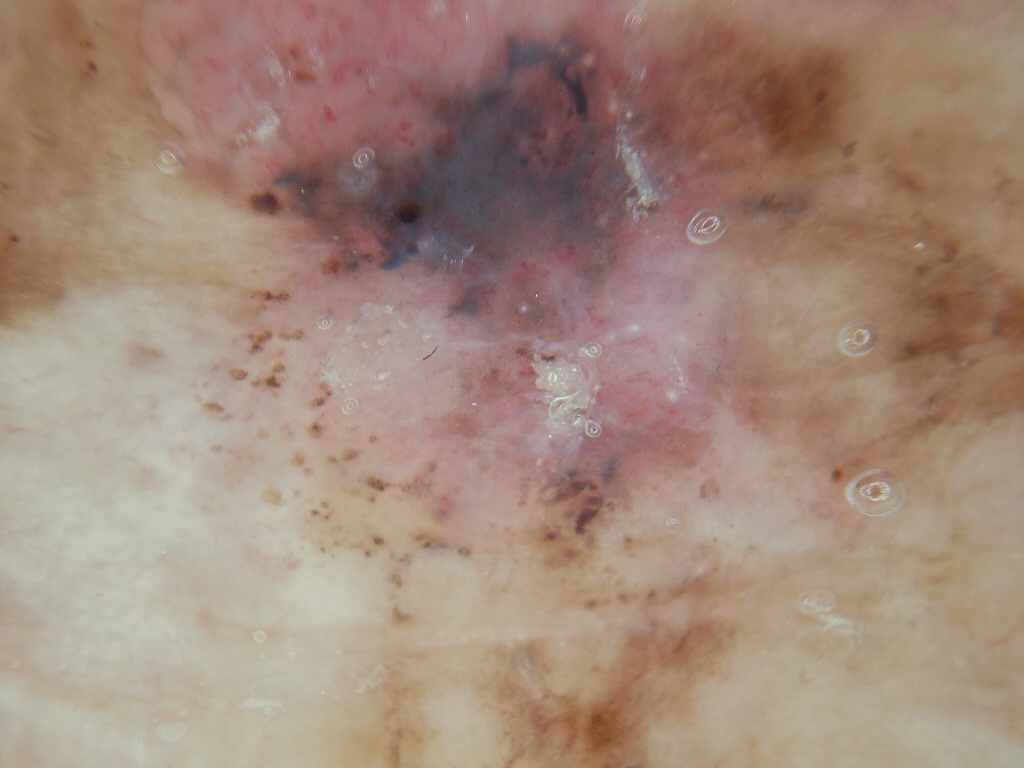 Bcc Object Detection Dataset And Pre Trained Model By Skin Cancer