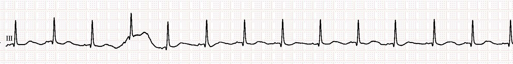 ecg-fl-approach Classification Dataset by EHealth
