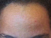 Acne Object Detection Dataset by Kritsakorn