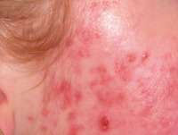 Acne Object Detection Dataset by Kritsakorn