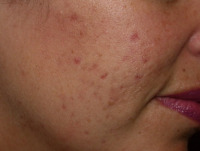 Acne Object Detection Dataset by Kritsakorn