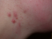 Acne Object Detection Dataset by Kritsakorn