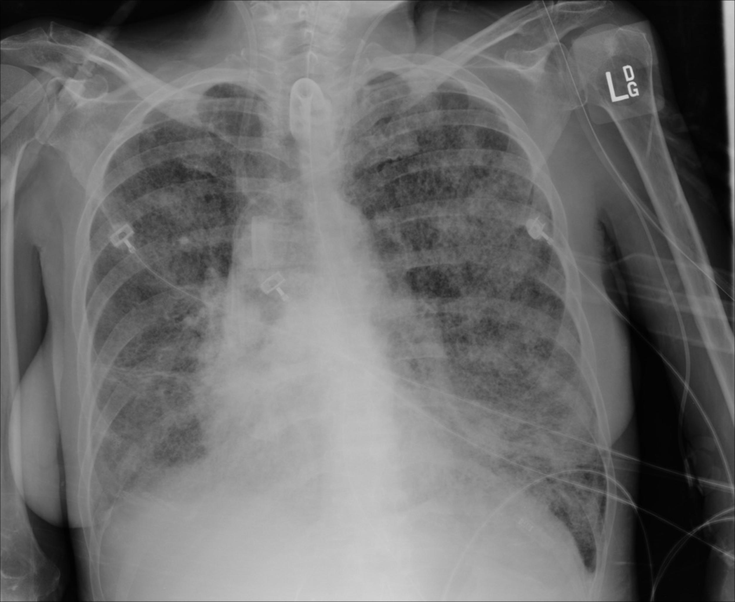 ET_TUBE Object Detection Dataset and Pre-Trained Model by ET Tube