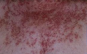 SKIN DISEASE Classification Dataset by NSC Proj