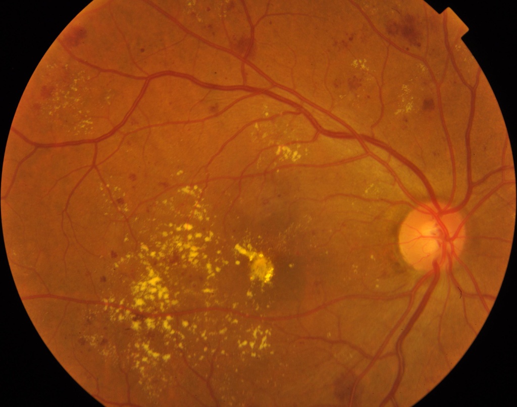 diabetic-retinopathy-detection biskra Object Detection Dataset by fayez diabetic-retinopathy-detection biskra Object Detection Dataset by fayez