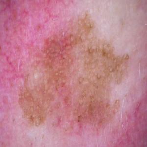 Skin Cancer Classification Dataset by Devanshu