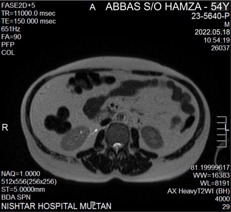 liver tumor detection Object Detection Dataset and Pre-Trained Model by ...