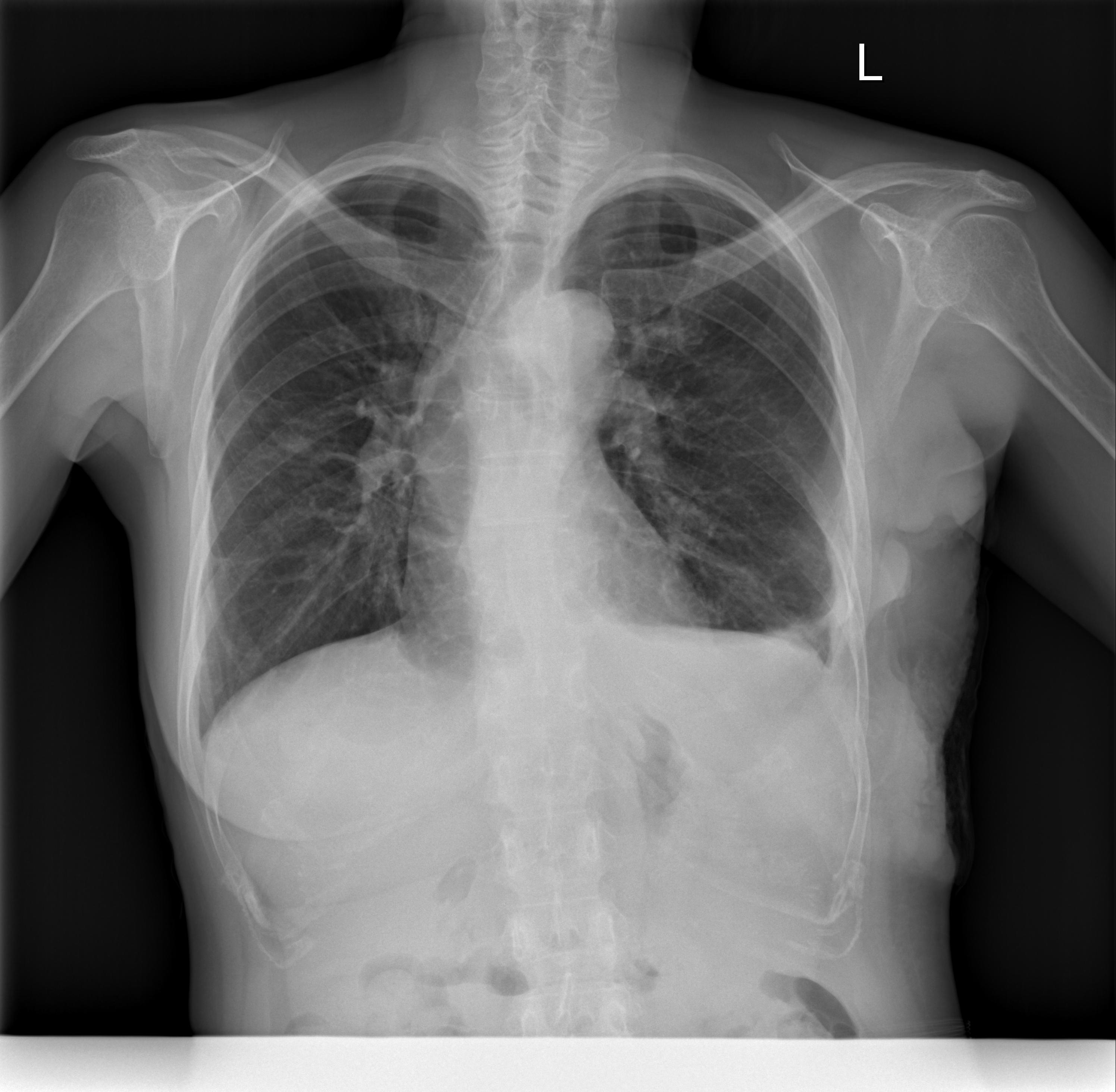 Top Hydropneumothorax Datasets and Models | Roboflow Universe