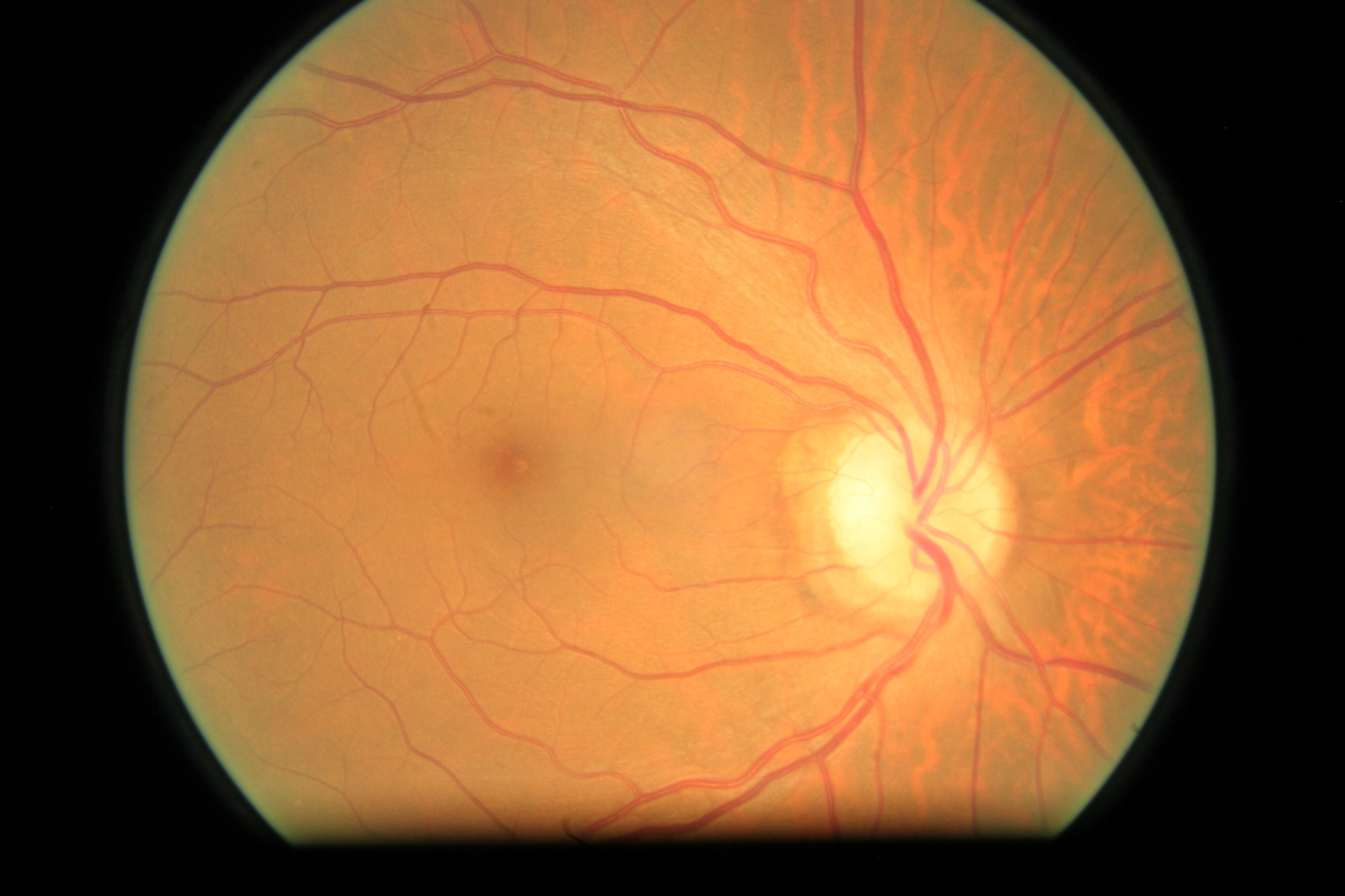 Glaucoma imgs Object Detection Dataset by INFO6517 Deep learning