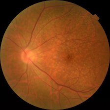 How to Use the Retinal Disease Classification Classification API