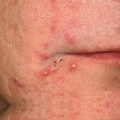 Acne Detection V2 Object Detection Dataset and Pre-Trained Model by Acne Project