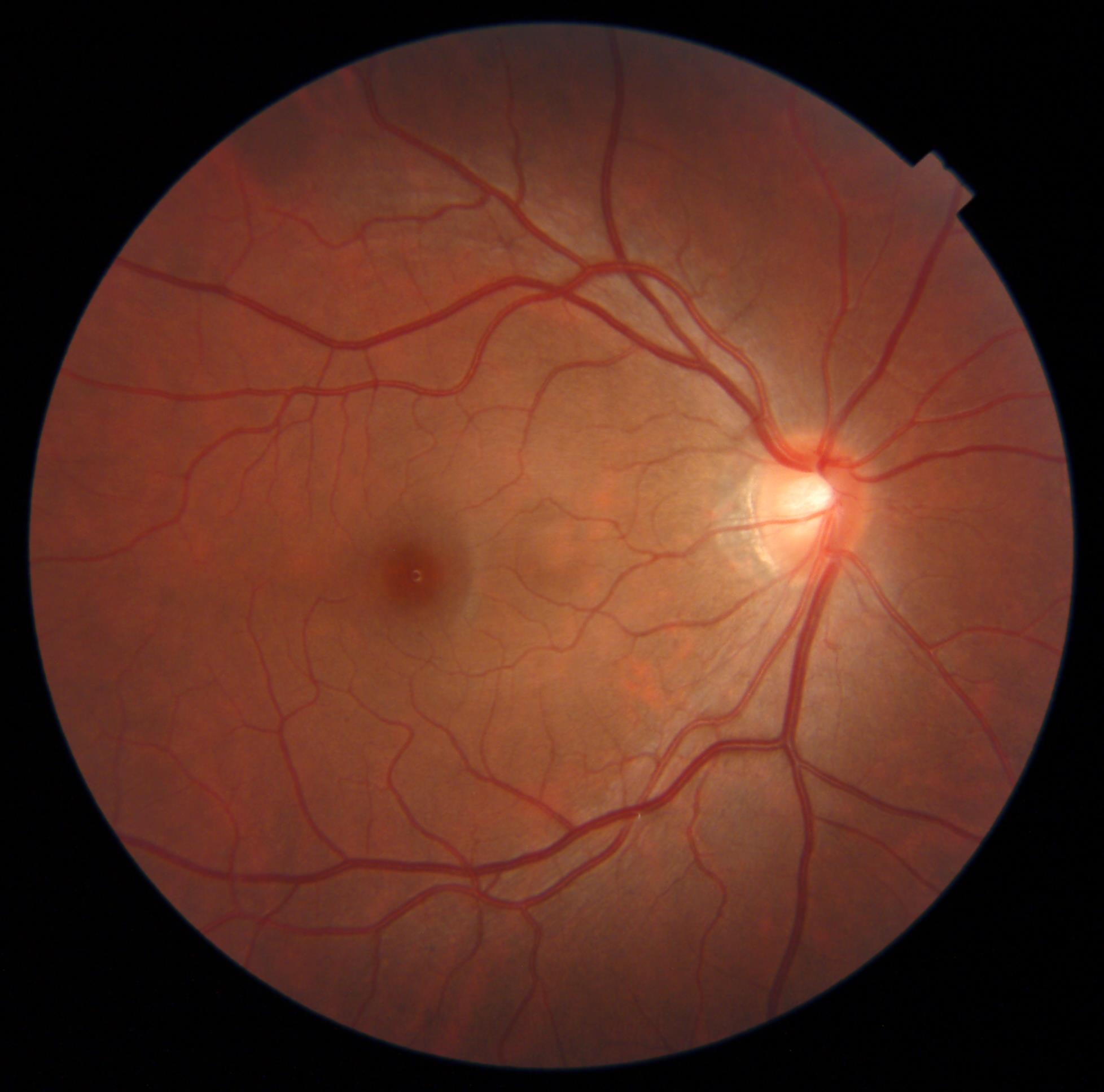 Diabetic_Retinopathy_Detection Object Detection Dataset by friedrichor Diabetic_Retinopathy_Detection Object Detection Dataset by friedrichor