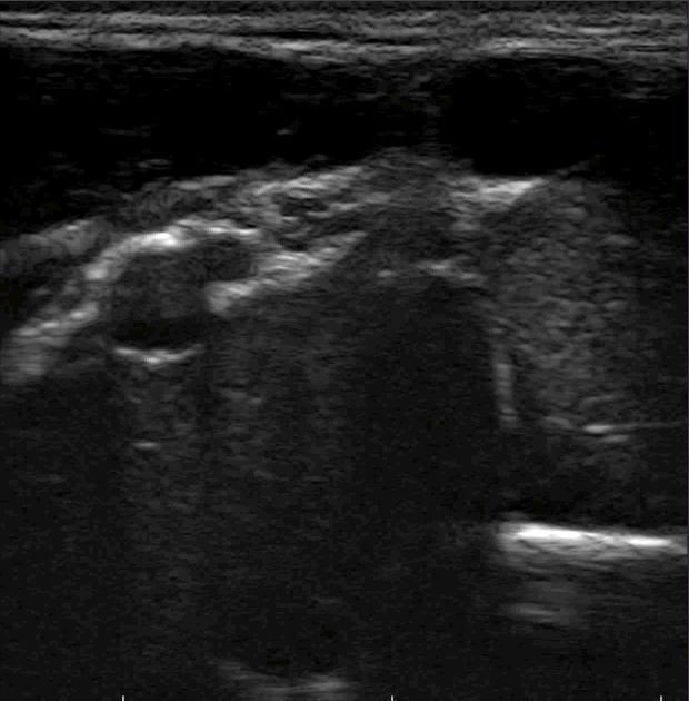 Ultrasound-basilic segmentation Instance Segmentation Dataset by Jas