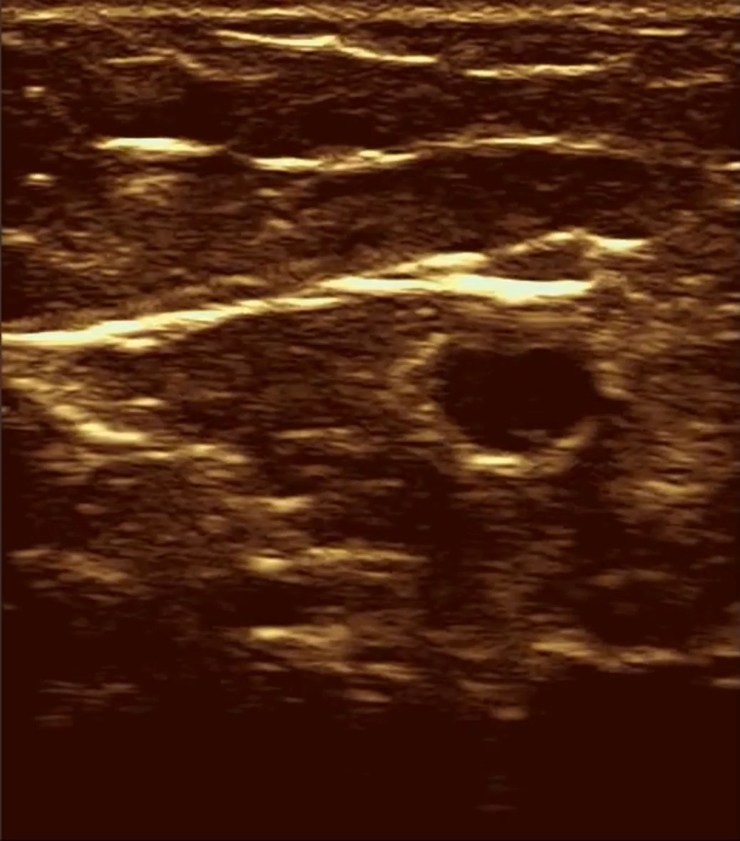 Ultrasound segmentation Yolo8 Instance Segmentation Dataset by Jas