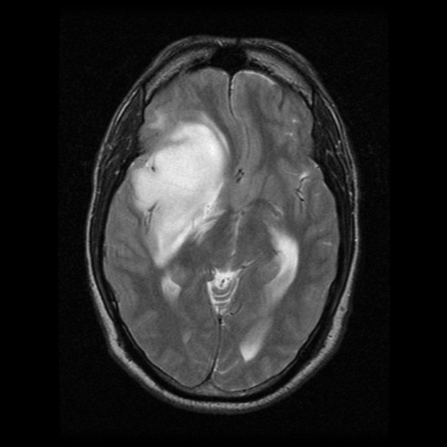 Brain tumor classification and segmentation Instance Segmentation Dataset and Pre-Trained Model ...