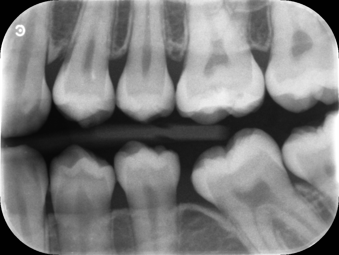 Caries Instance Segmentation Dataset by 0